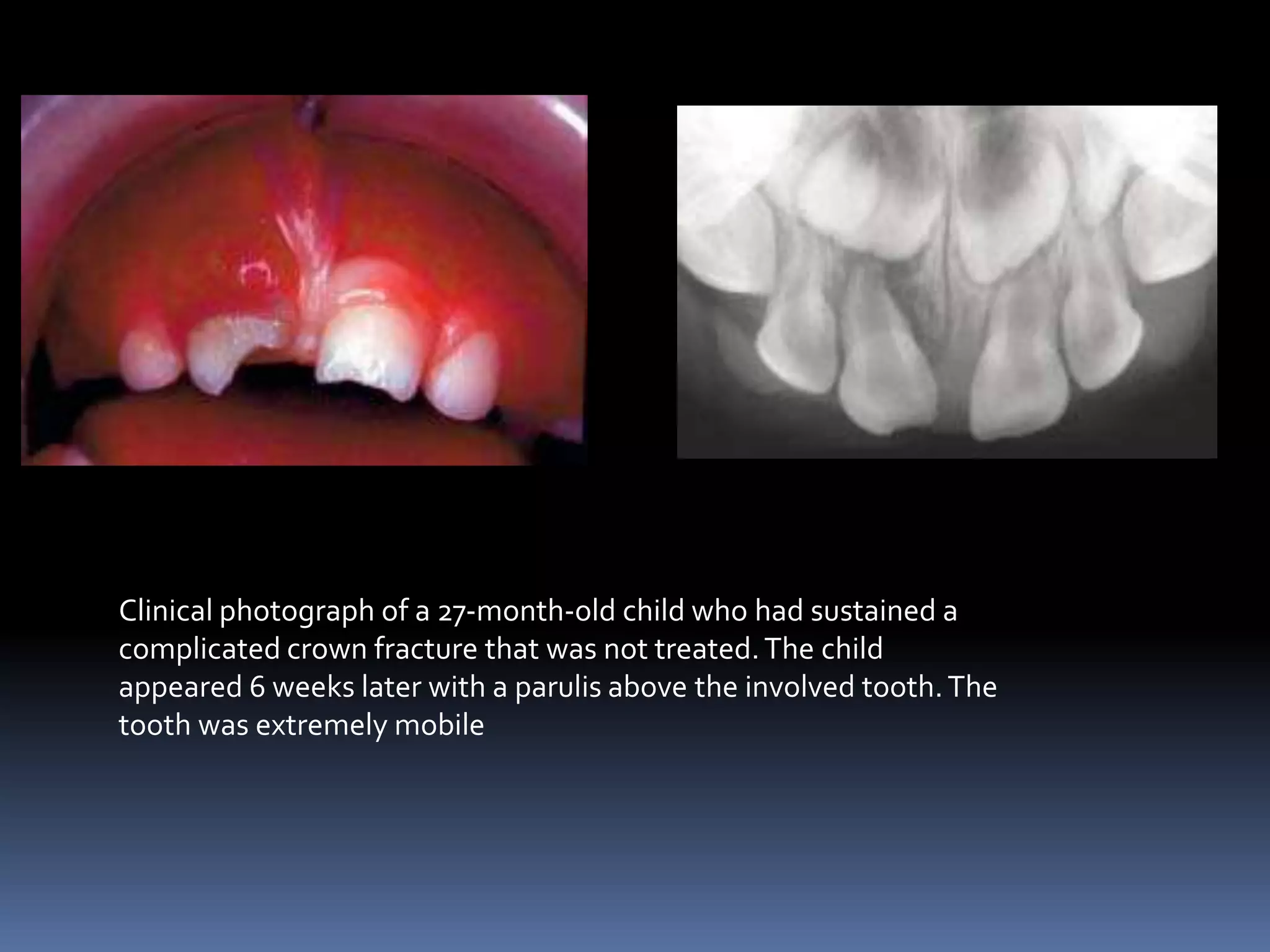 Management of traumatic dental injury of primary teeth | PPTX