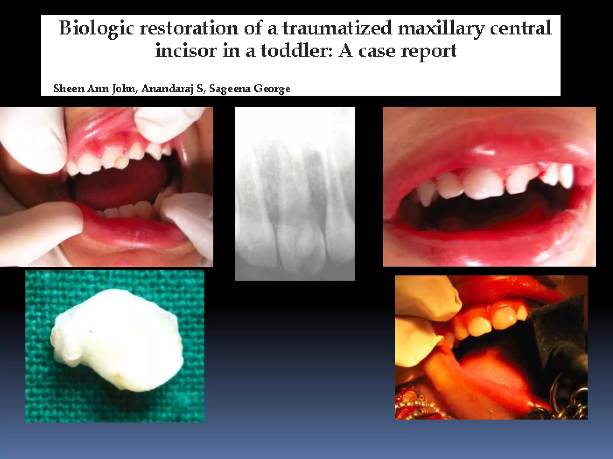 Management of traumatic dental injury of primary teeth | PPTX