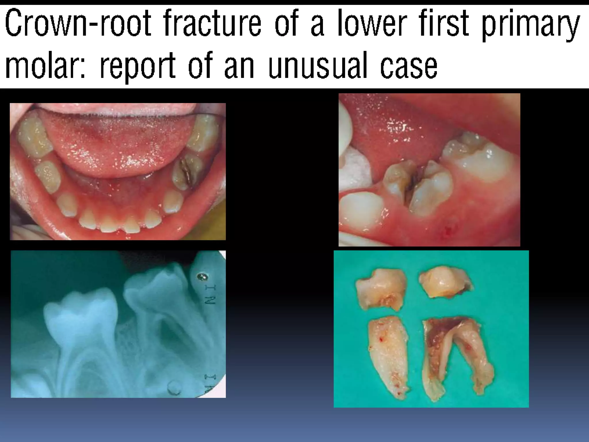 Management of traumatic dental injury of primary teeth | PPTX