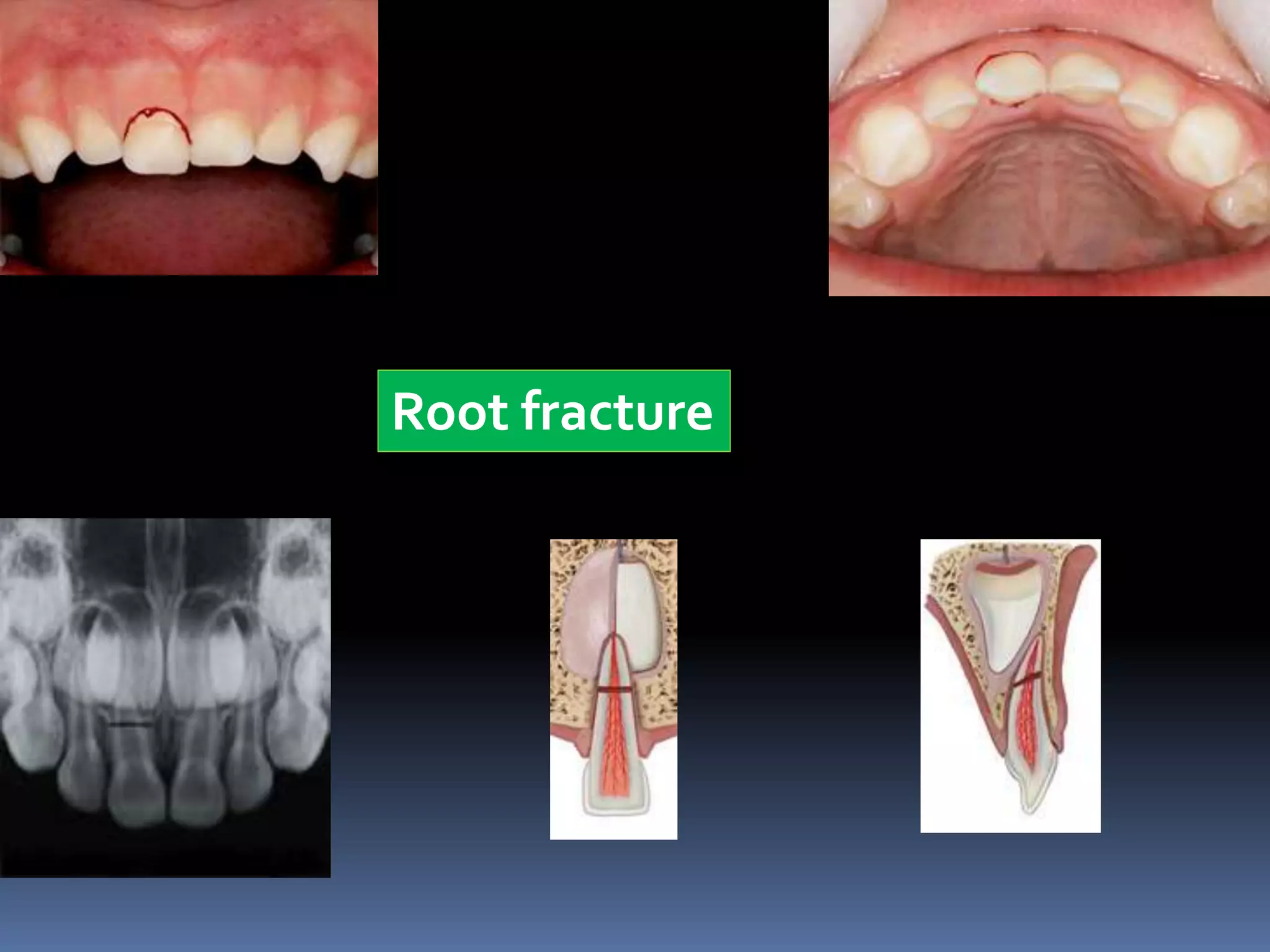Management of traumatic dental injury of primary teeth | PPTX