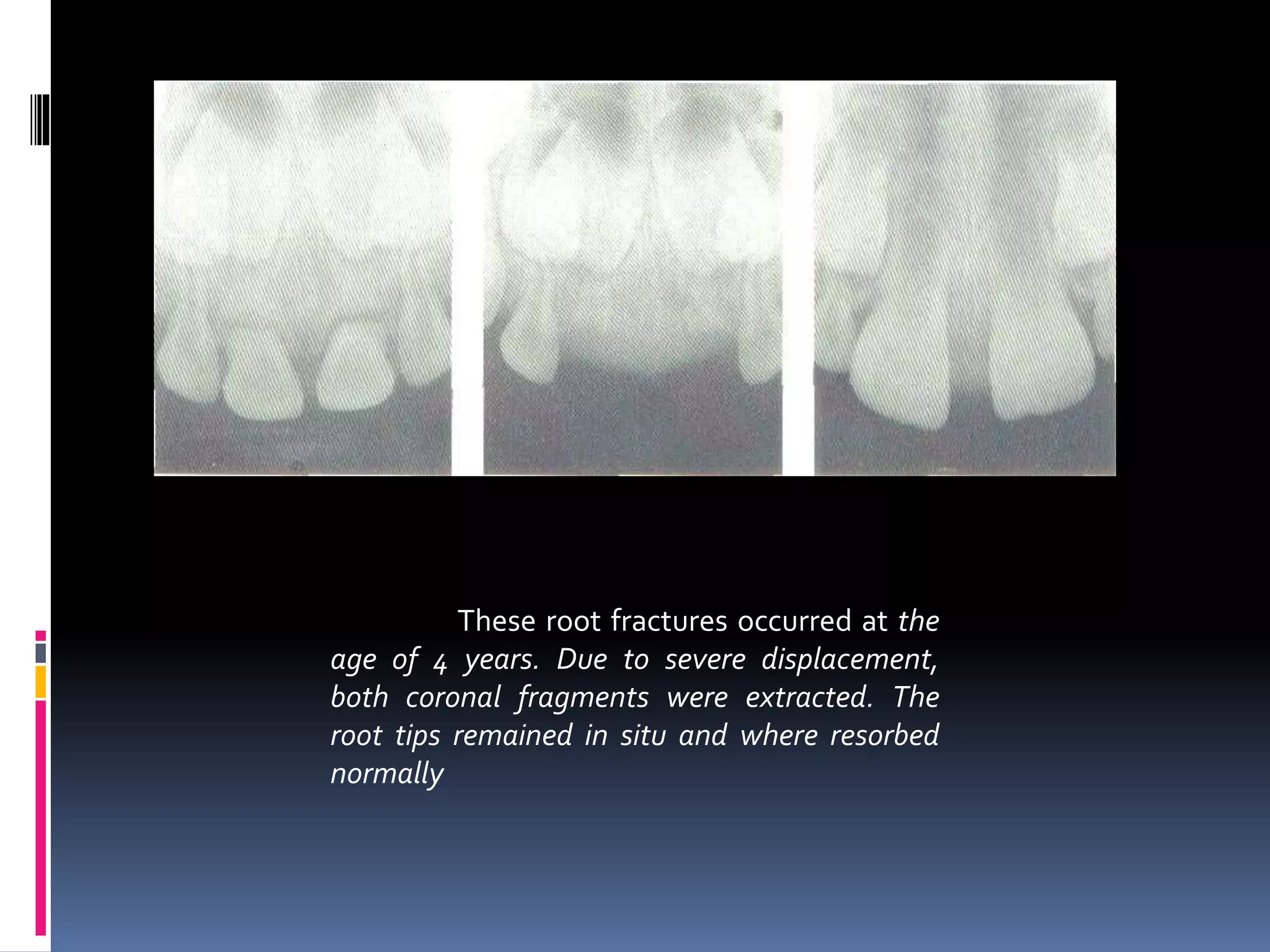 Management of traumatic dental injury of primary teeth | PPTX