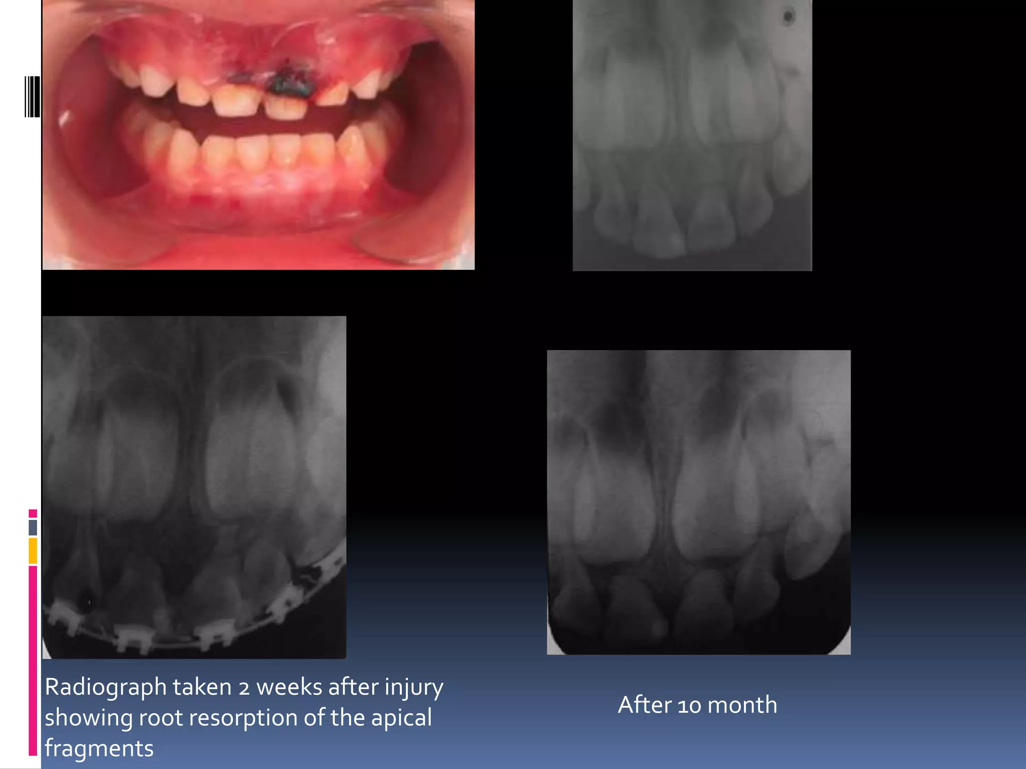 Management of traumatic dental injury of primary teeth | PPTX