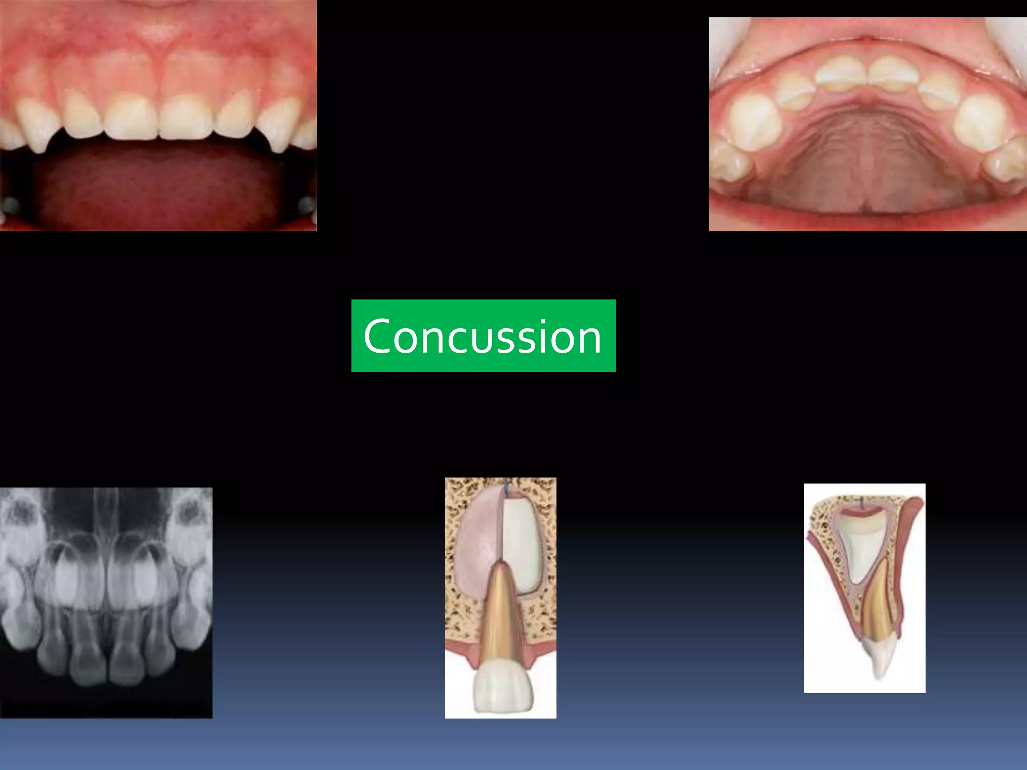 Management of traumatic dental injury of primary teeth | PPTX