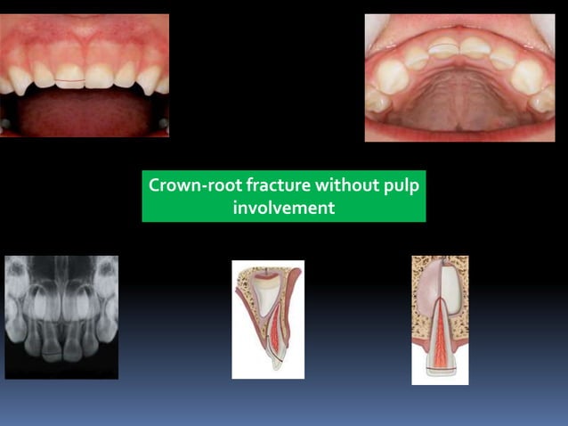 Management of traumatic dental injury of primary teeth | PPTX | Dental ...