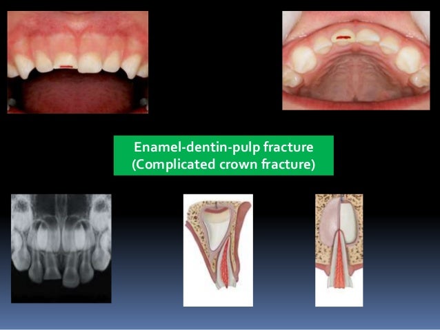 Management of traumatic dental injury of primary teeth