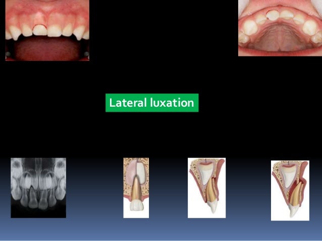 Management of traumatic dental injury of primary teeth