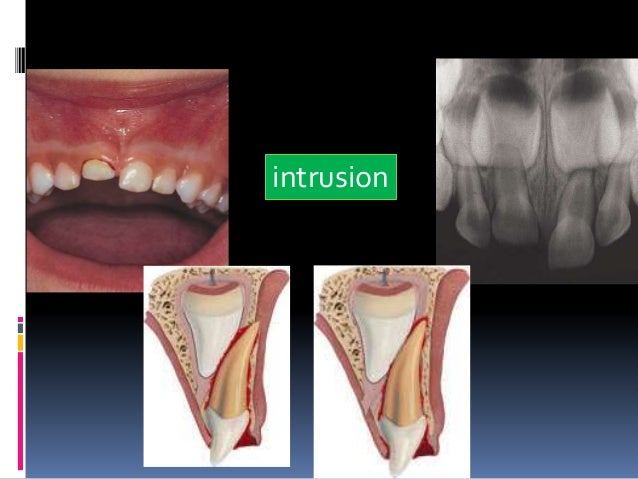 Management of traumatic dental injury of primary teeth