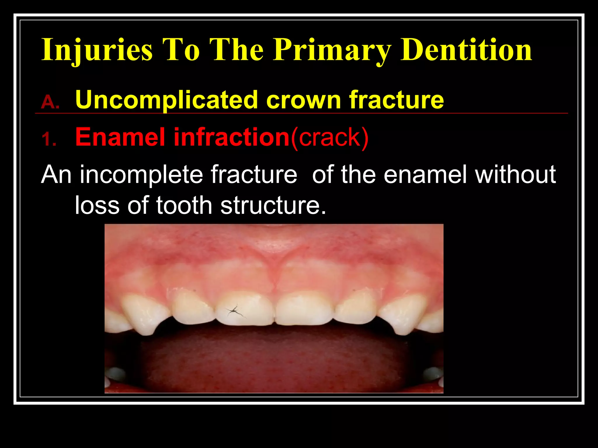 Management of traumatic lesions to primary dentition | PPT