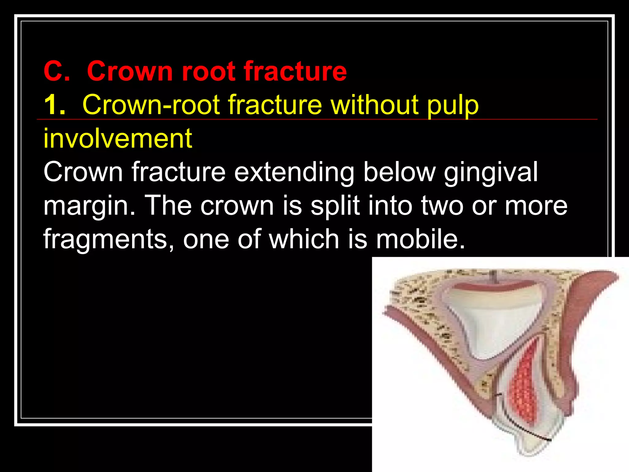 Management of traumatic lesions to primary dentition | PPT