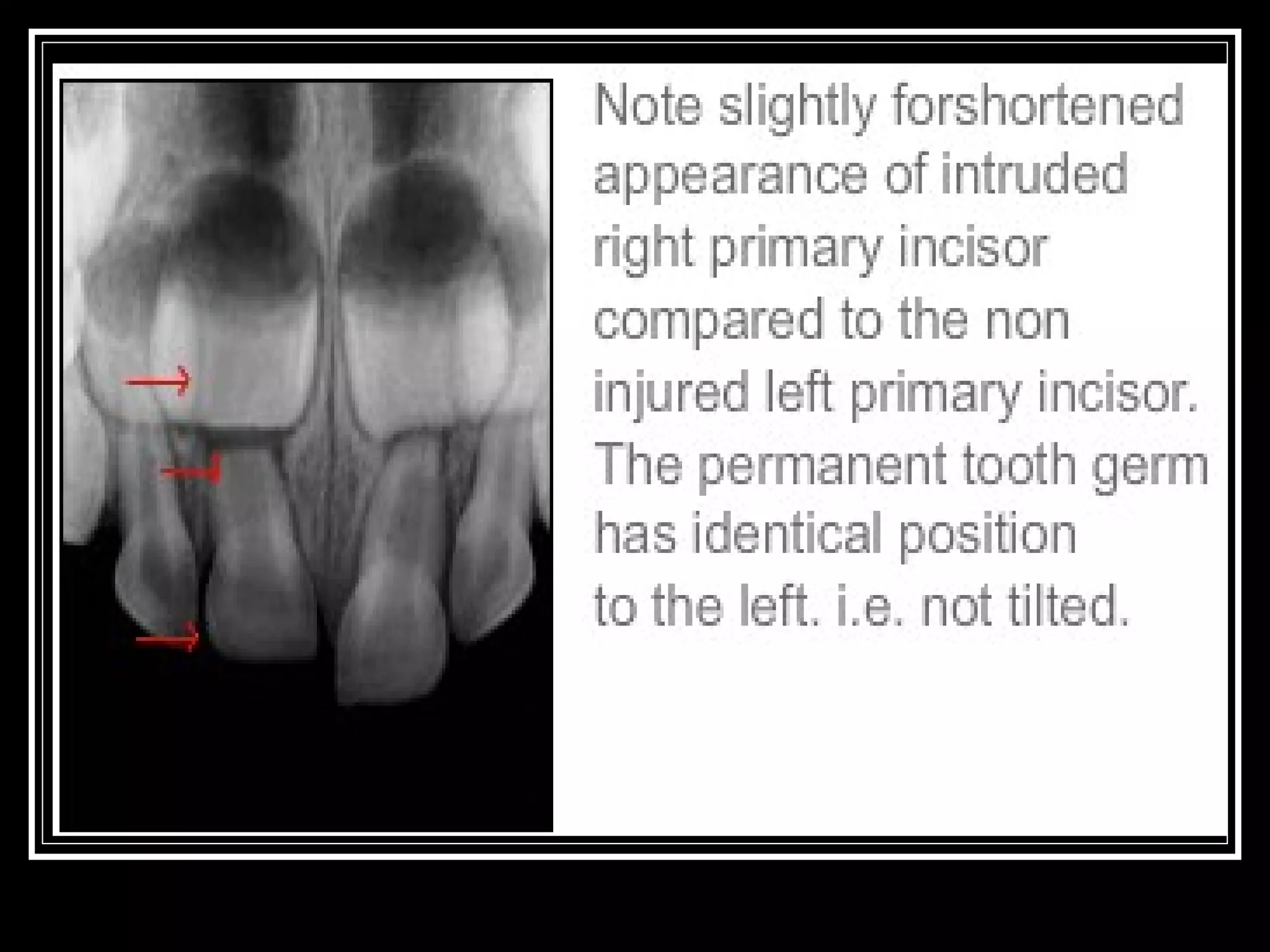 Management of traumatic lesions to primary dentition | PPT