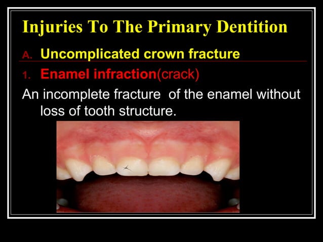 Management of traumatic lesions to primary dentition | PPT