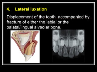 Management of traumatic lesions to primary dentition | PPT