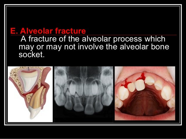 Management of traumatic lesions to primary dentition