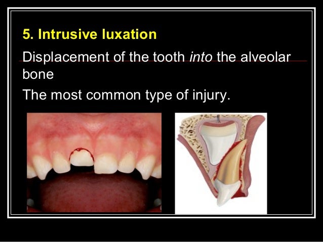 Management of traumatic lesions to primary dentition