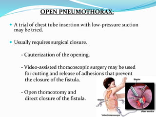 Management of traumatic pneumothorax and haemothorax | PPTX