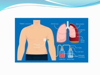 Management of traumatic pneumothorax and haemothorax | PPTX