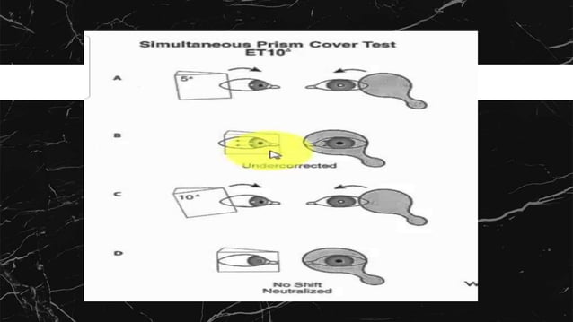 Management of tropia by prisms.pptx | Eye and Vision Conditions ...