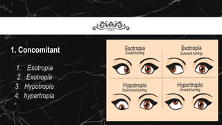 Management of tropia by prisms.pptx