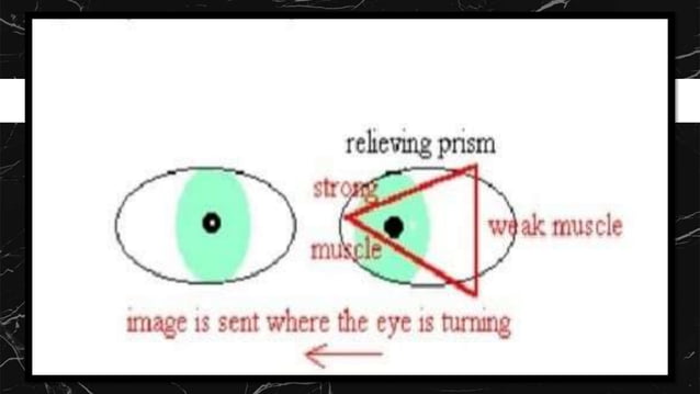 Management of tropia by prisms.pptx | Eye and Vision Conditions ...