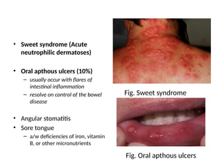 Management of Ulcerative Colitis: Adjunctive therapies, Surgical ...