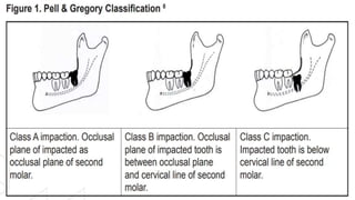 Management of Unerupted & Impacted 3rd molar.pptx
