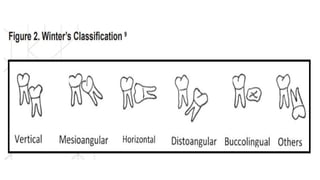 Management of Unerupted & Impacted 3rd molar.pptx
