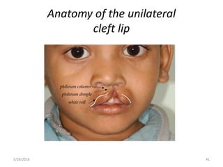 Unilateral Cleft Lip And Palate