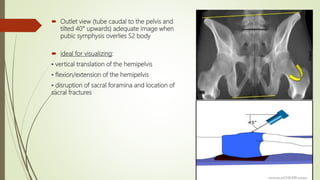 Management of pelvic ring fractures [autosaved] | PPTX