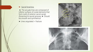 Management of pelvic ring fractures [autosaved] | PPTX