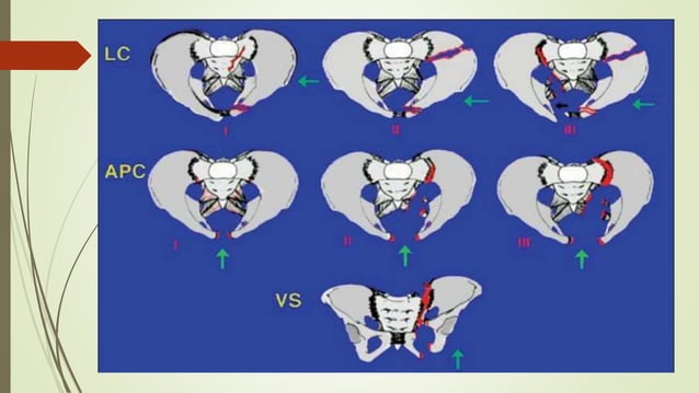 Treatment Of Pelvic Injuries / Pelvic Ring Fractures – AQAN