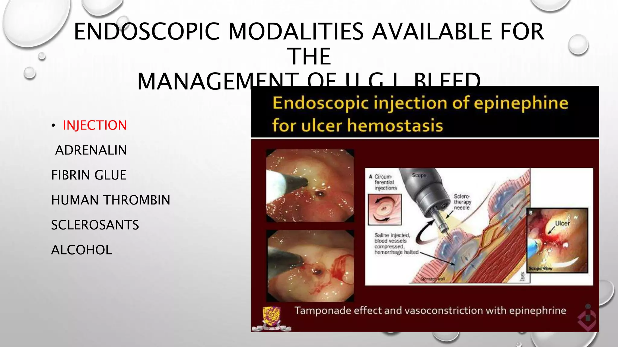 Management of upper gi bleeding | PPTX