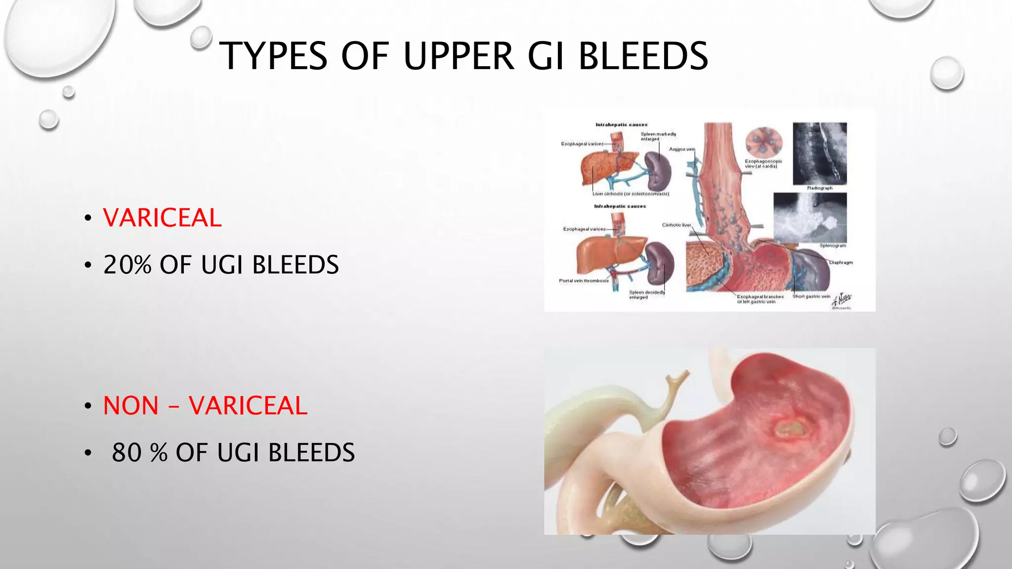 Management of upper gi bleeding | PPTX