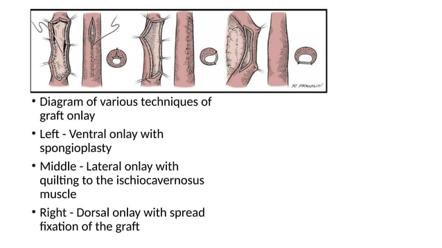 Presentation on Management of Urethral Strictures.pptx