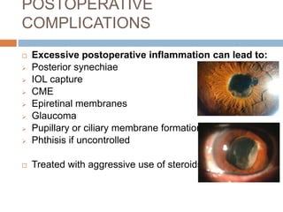 Management of Uveitic Cataract | PPTX