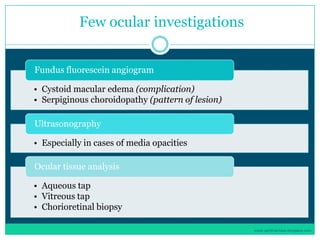 Management of uveitis | PPTX