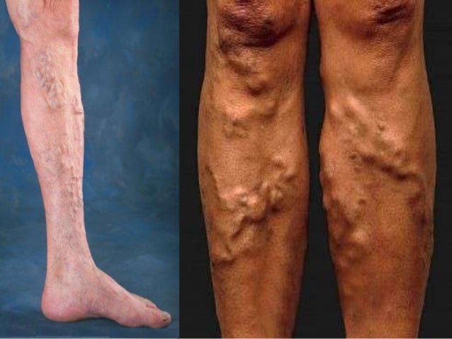 Management of varicose veins RRT