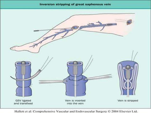 Management of varicose veins RRT