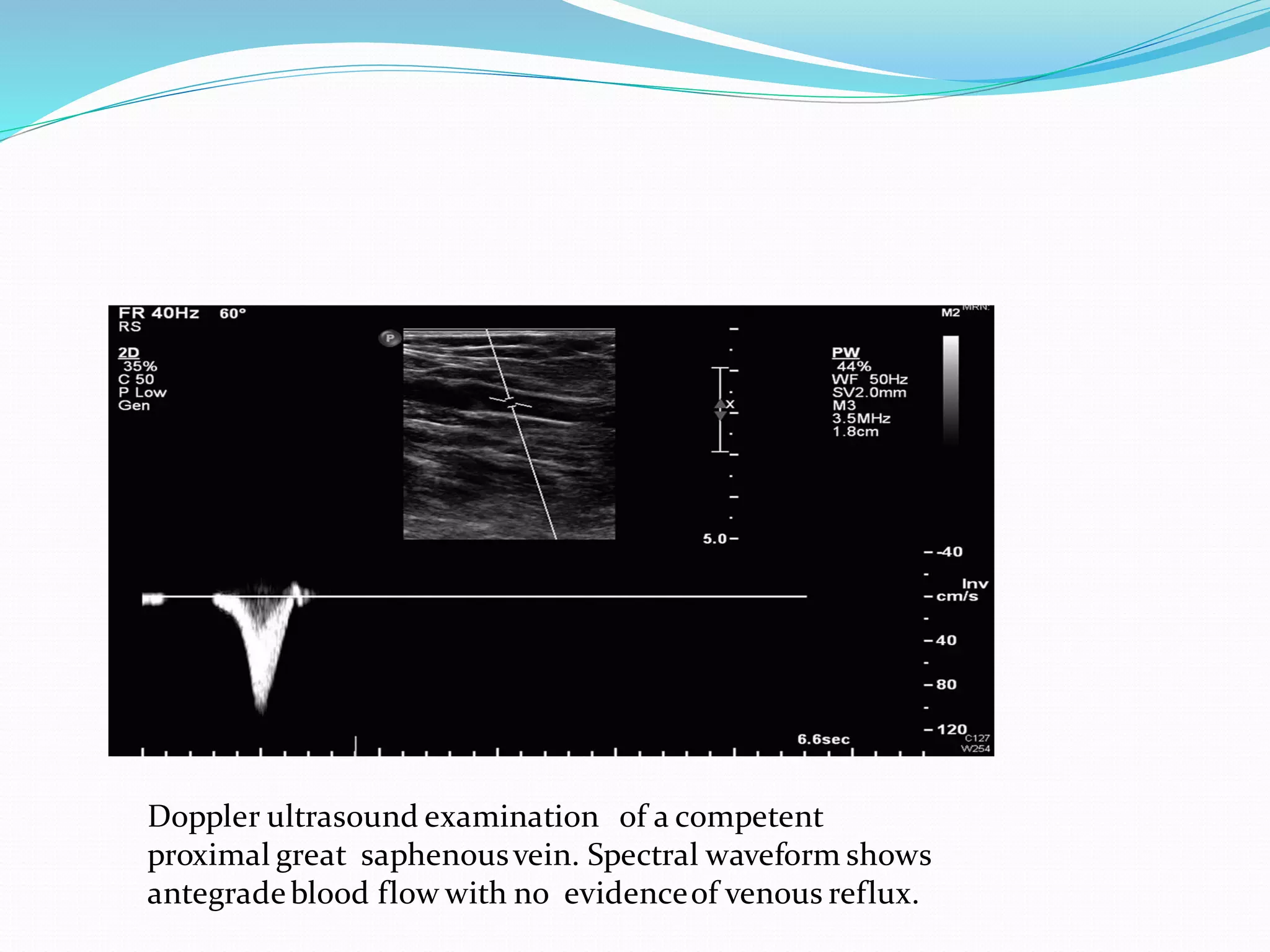 Management of varicose veins | PDF