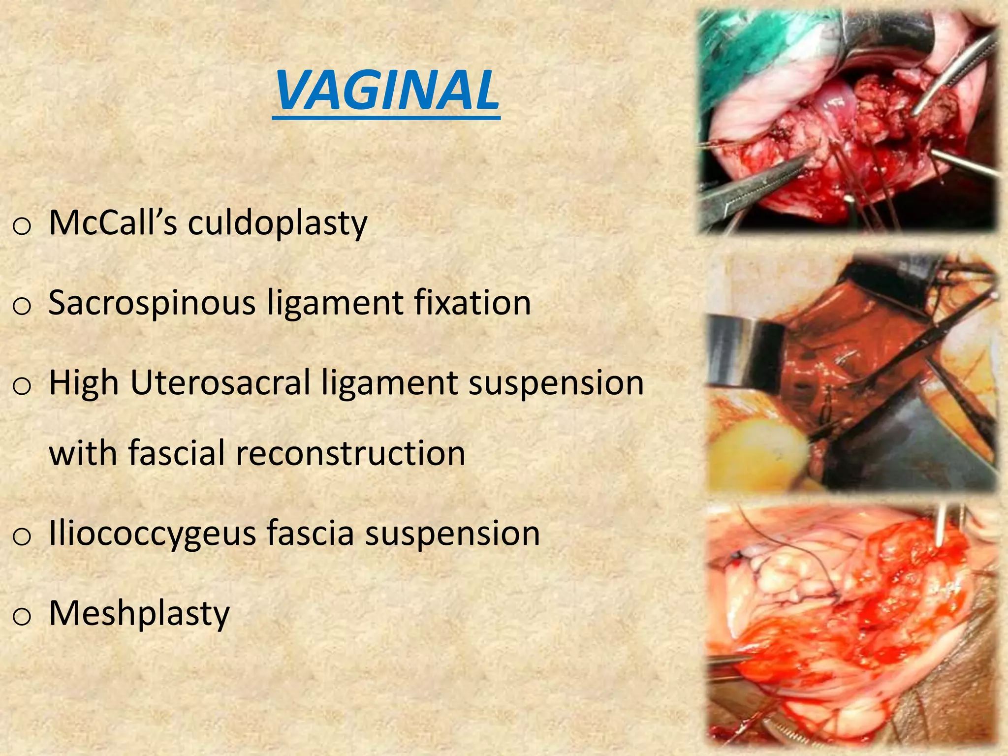 MANAGEMENT OF VAULT PROLAPSE BY DR SHASHWAT JANI | PPTX