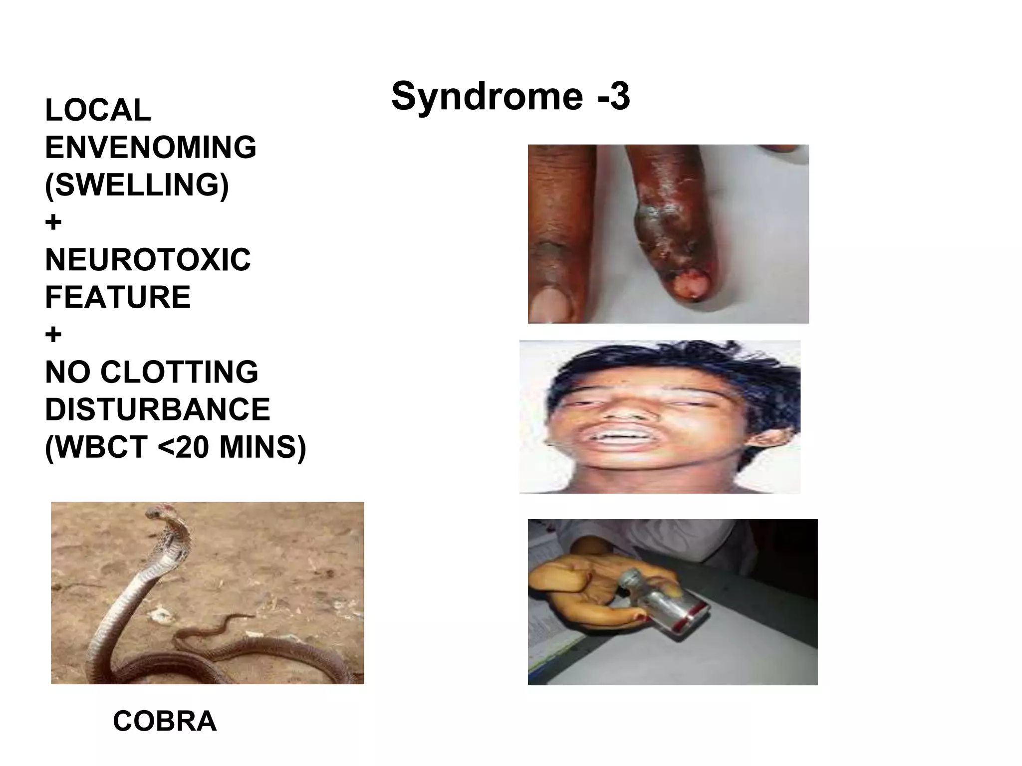 Management of venomous snake bite | PPT