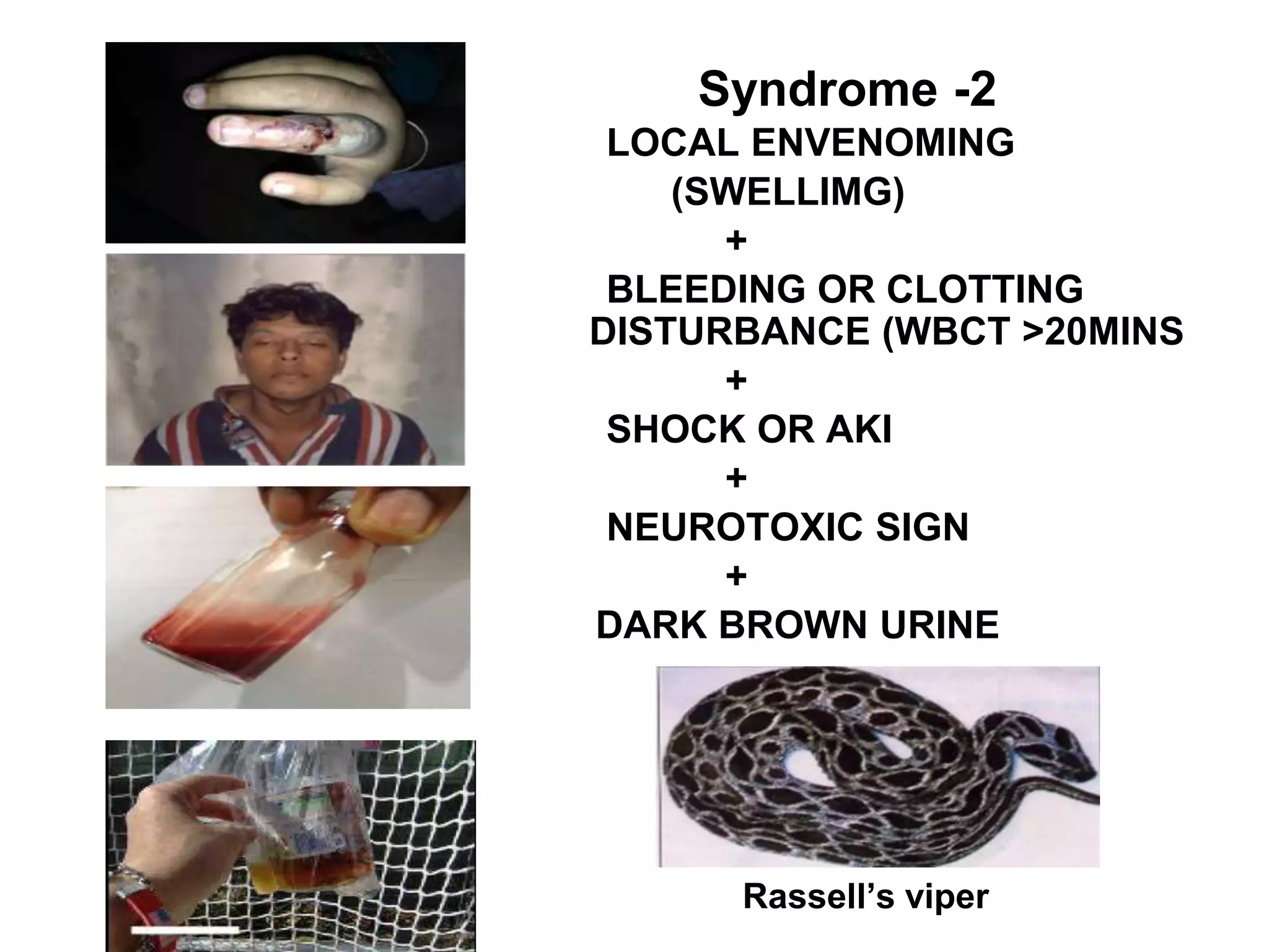 Management of venomous snake bite in Bangladesh | PPTX