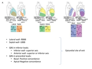 Management of ventricular tachyarrythmias | PPTX