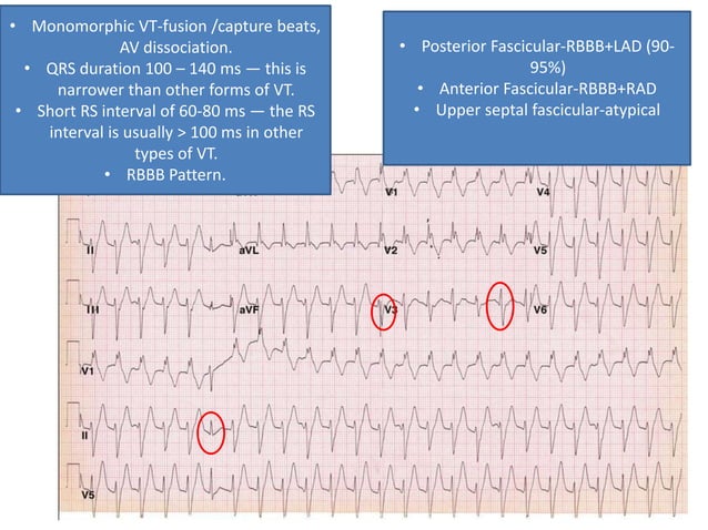 Management of ventricular tachyarrythmias | PPTX