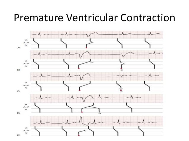 Management of ventricular tachyarrythmias