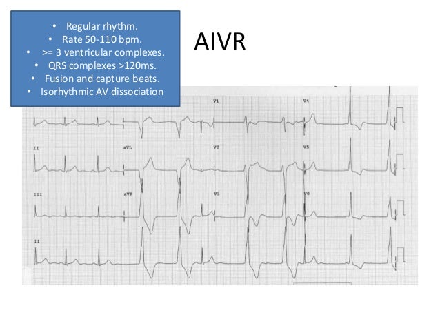 Management of ventricular tachyarrythmias