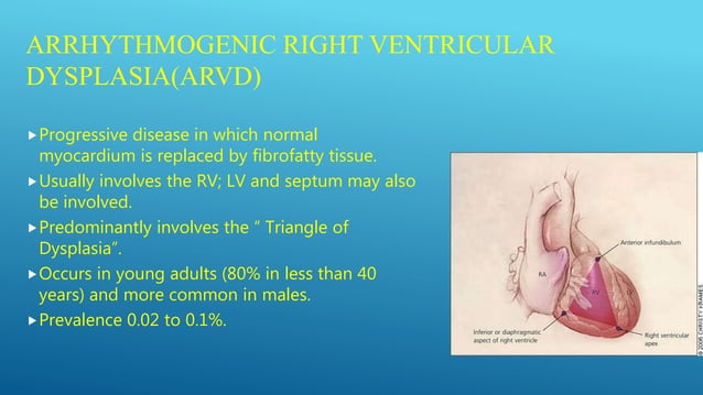 Management of VENTRICULAR TACHYCARDIA (VT) | PPTX | Heart and ...