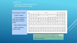 Management of VENTRICULAR TACHYCARDIA (VT) | PPTX