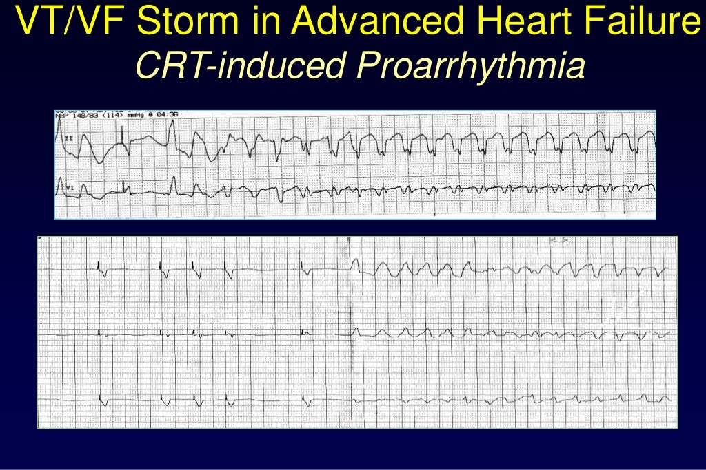 Management of vt vf storm in advanced heart failure