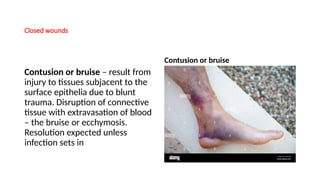 Wounds and Principles of Wound Management | PPTX