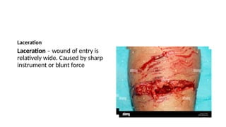 Wounds and Principles of Wound Management | PPTX